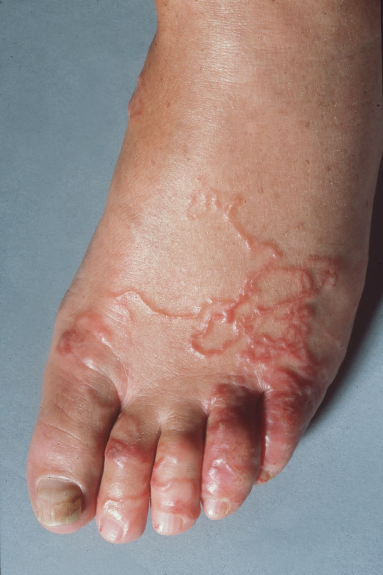 Vorsicht, Parasiten - Reisedermatosen – Unliebsame Mitbringsel aus den ...