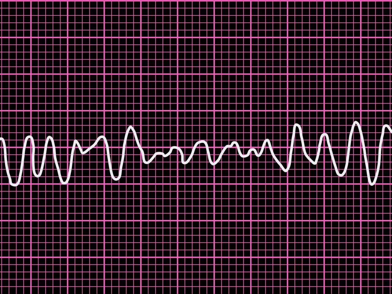 Herzrhythmusstörungen - Wenn das Herz stolpert und rast: Wann zum Arzt ...