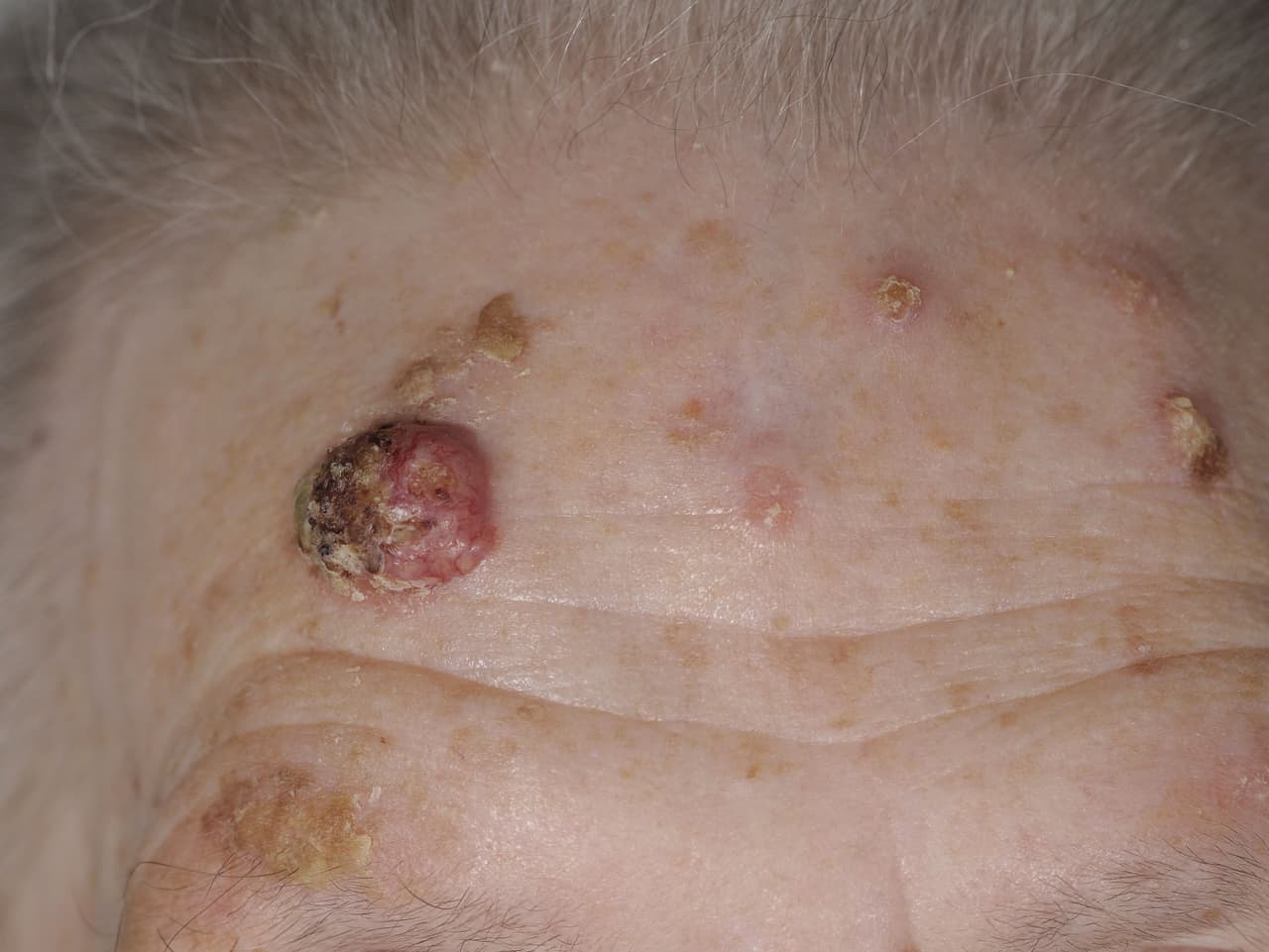 Verdächtige Hautveränderung - Weisser Hautkrebs tarnt sich gut - Wissen ...