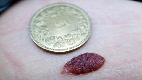 Wann muss ein Muttermal weg? - Wissen - SRF