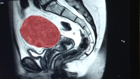 Hysterektomie - Gebärmutterentfernung kann die Lösung verschiedener Leiden sein - Wissen - SRF