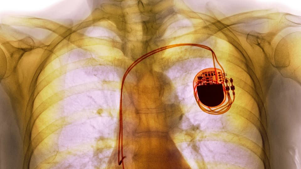 Körper & Geist - Implantierbare Defibrillatoren mit Tücken - Puls - SRF