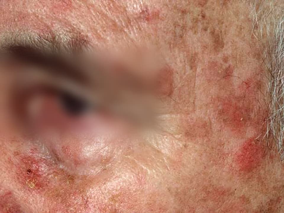 Unterschätzte Gefahr - Weisser Hautkrebs auf dem Vormarsch - Wissen - SRF