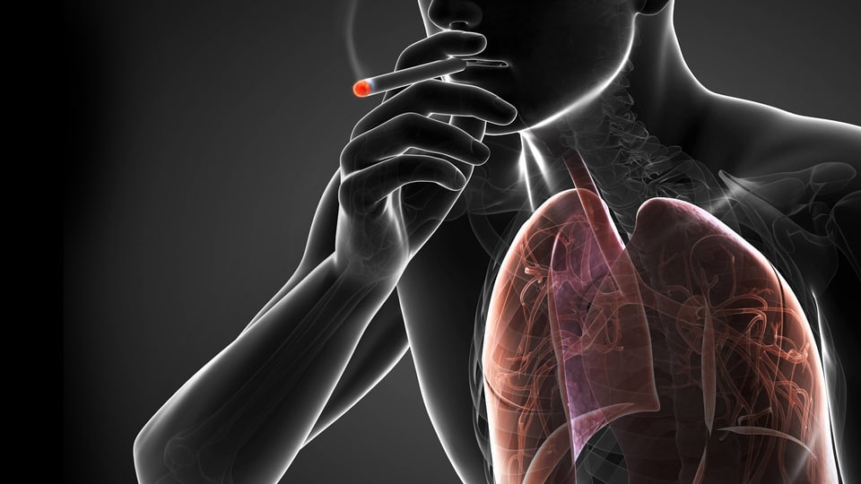 «Raucherlunge» - Viele Raucher sind kränker als sie meinen - Wissen - SRF