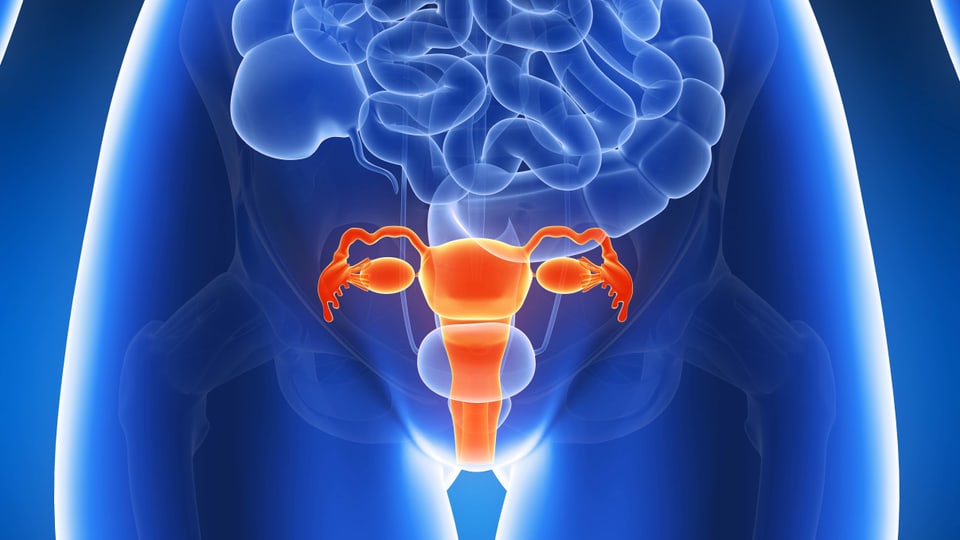 Weniger Invasiv - Myome – Zu viele Gebärmütter werden ohne Not entfernt ...