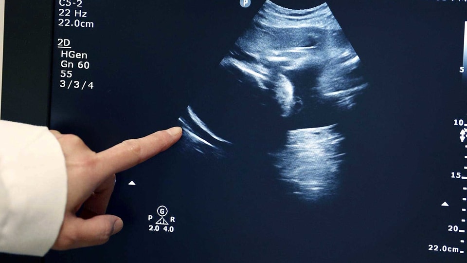 Spina-Bifida-Operation - Offener Rücken bei Föten: Hat sich die OP vor ...