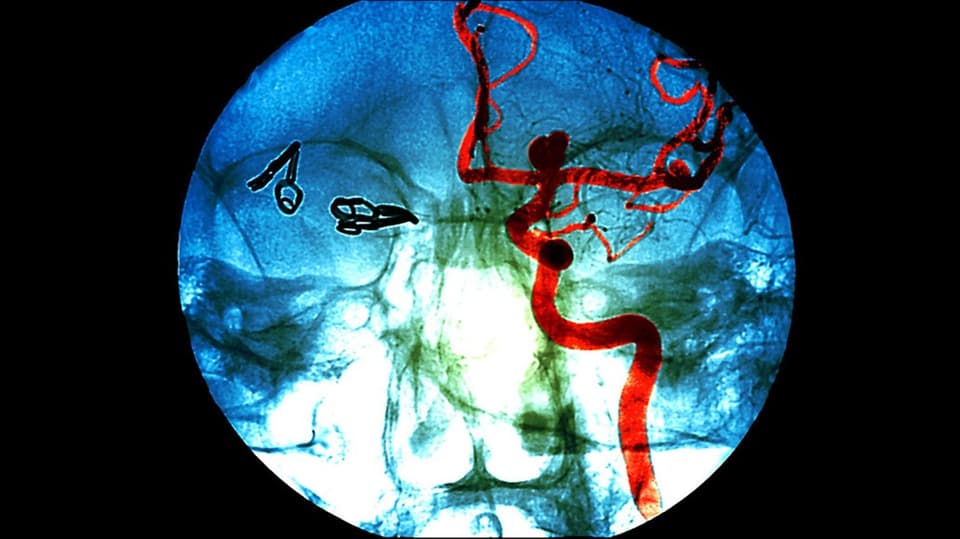 Gefahr im Blutgefäss - Zeitbombe Aneurysma: Hoffnung auf ein Medikament ...