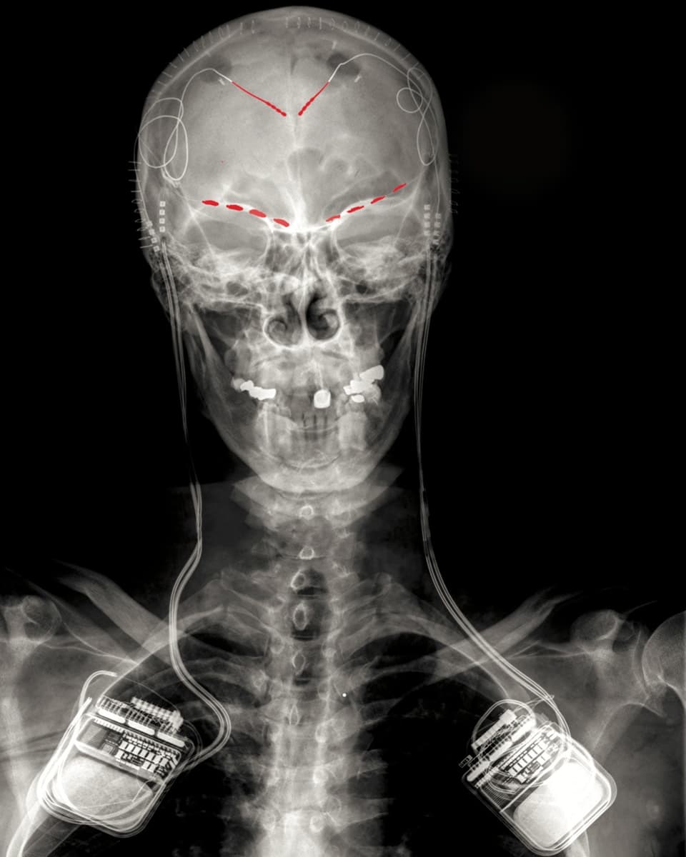 Hirnforschung - Der chronische Schmerz sitzt direkt hinter der Stirn ...