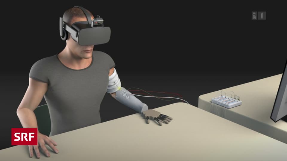 - Ein Gespür für die Handprothese - Wissen - SRF