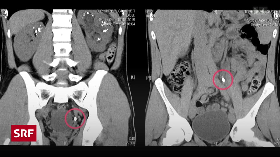 - Volkskrankheit Nierenstein - Wissen - SRF